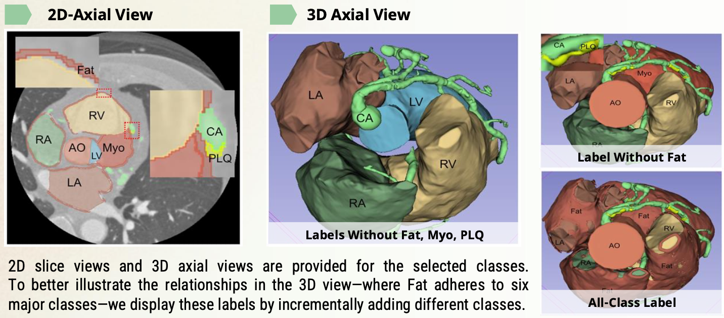 Multi-Class Segmentation for 3D Cardiac CT in NVIDIA GTC 2025 Poster ...